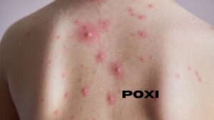 Understanding Poxi: Causes, Symptoms, and Treatment Options - Cafelam
